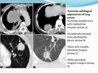 Lymph nodal stations in ca lung | PPTX