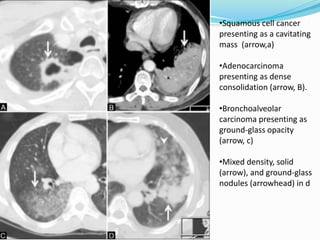 Lymph nodal stations in ca lung | PPTX