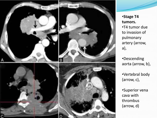 Lymph nodal stations in ca lung | PPTX