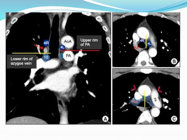Lymph nodal stations in ca lung | PPTX