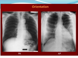 Lymph nodal stations in ca lung | PPTX