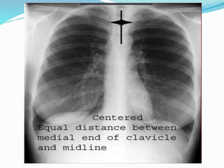 Lymph nodal stations in ca lung | PPTX