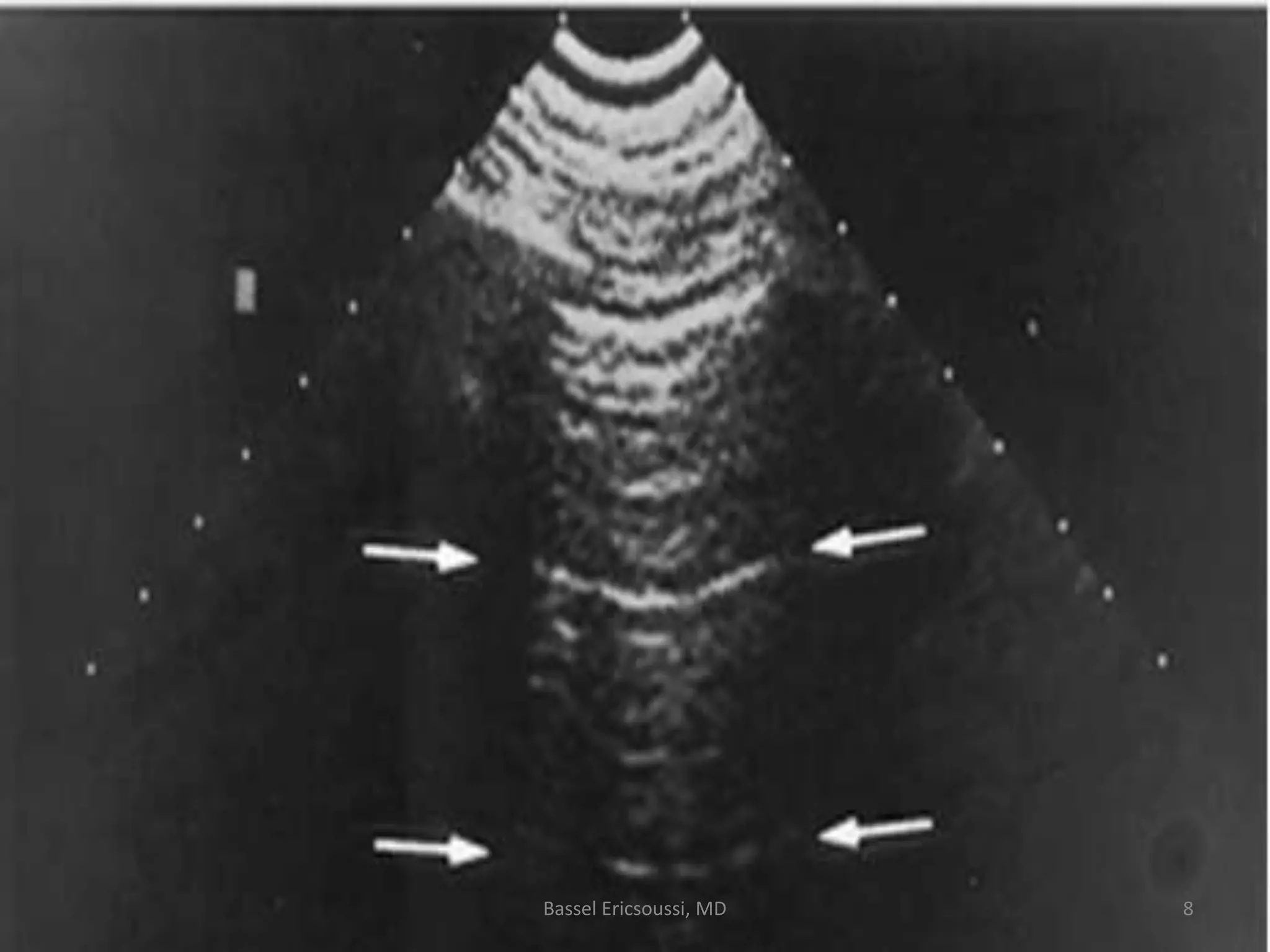 Lung and Pleural Ultrasonography - Ultrasound Guided Vascular Access ...