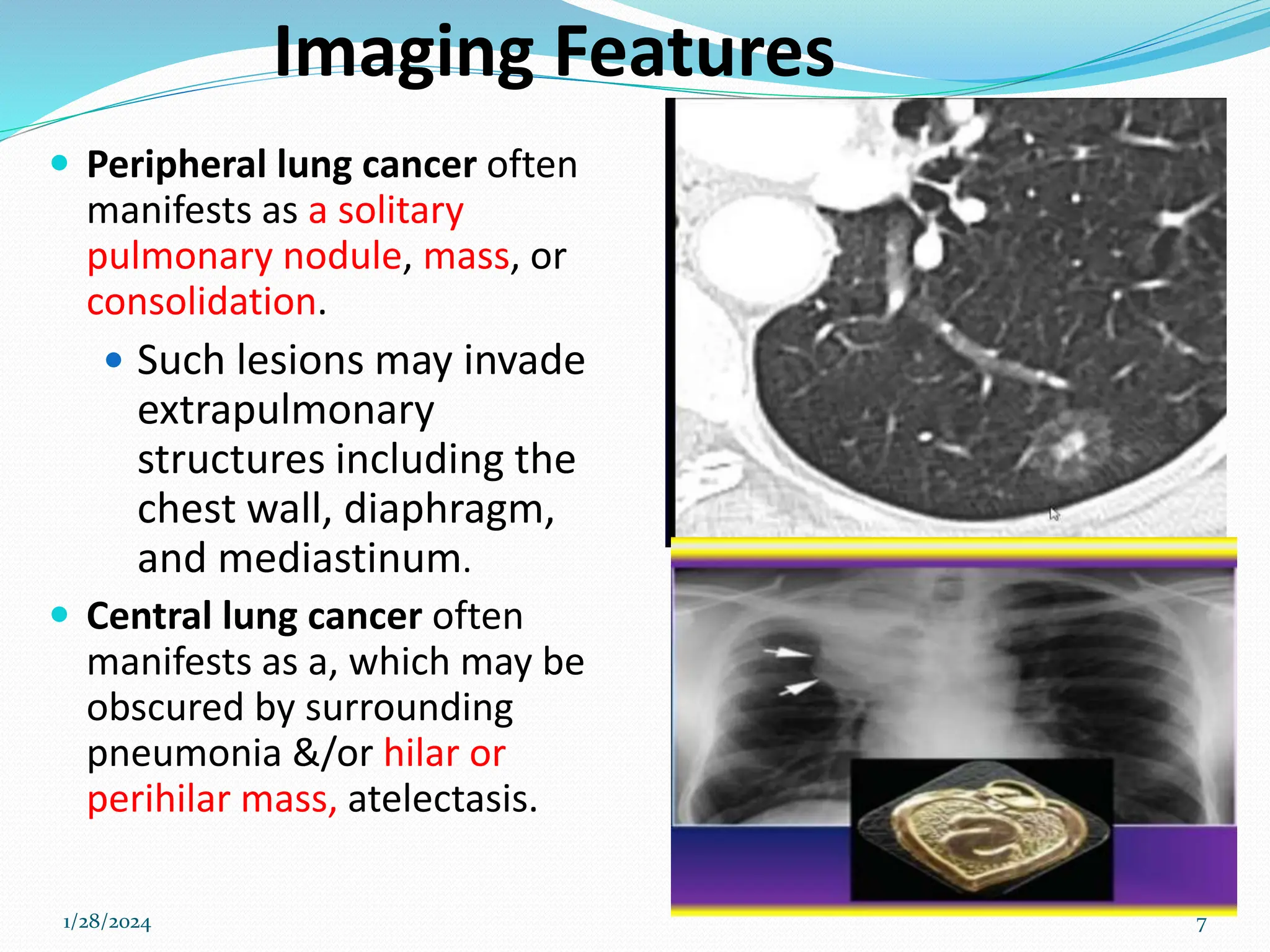 Lung Cancer and bronchopulmonary neoplasia | PPTX