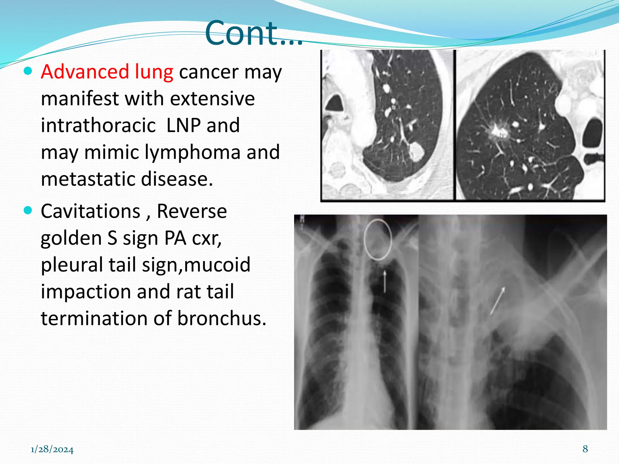 Lung Cancer and bronchopulmonary neoplasia | PPTX