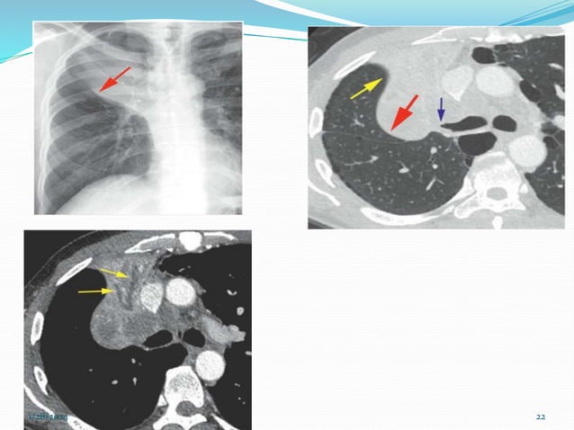 Lung Cancer and bronchopulmonary neoplasia | PPT
