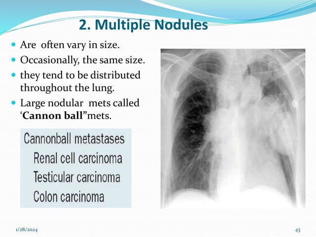 Lung Cancer and bronchopulmonary neoplasia | PPT