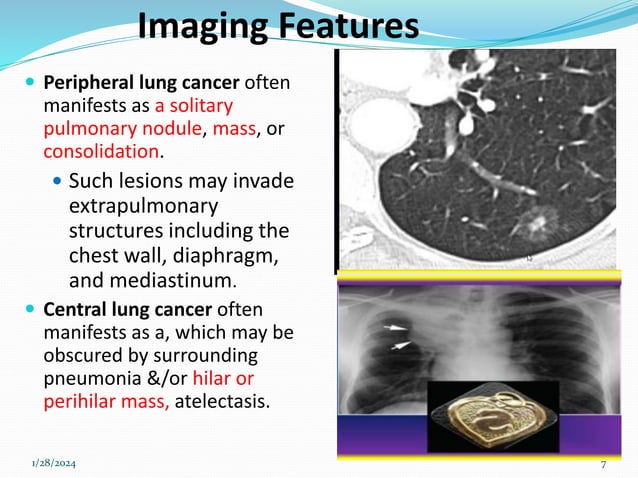 Lung Cancer and bronchopulmonary neoplasia | PPT