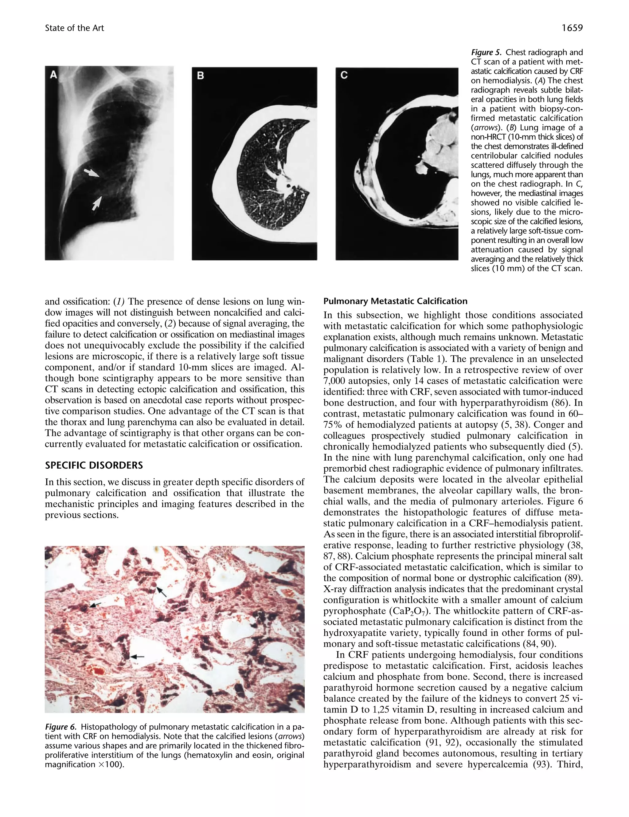 Lung calcium ajrccm.full