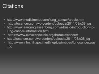 Lung cancer | PPT