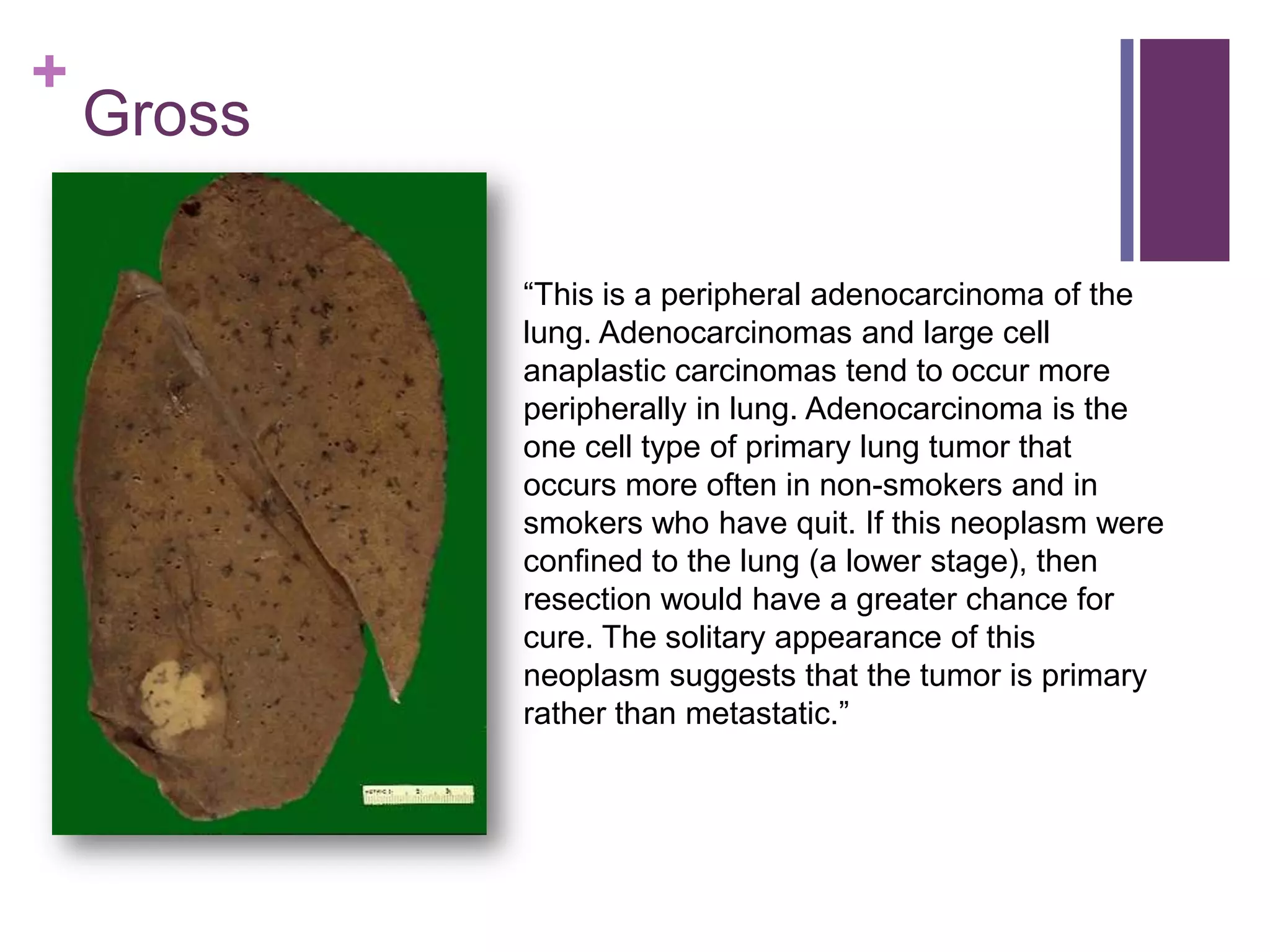 Lung Cancer Pathology & Clinical | PPTX