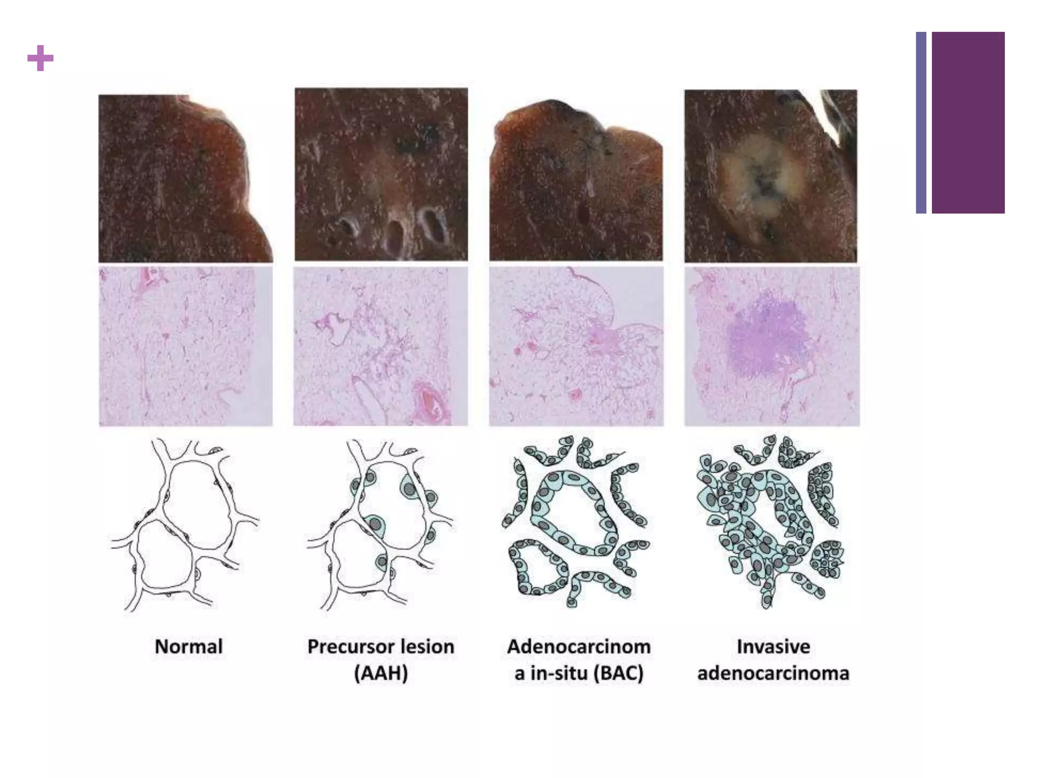 Lung Cancer Pathology & Clinical | PPTX