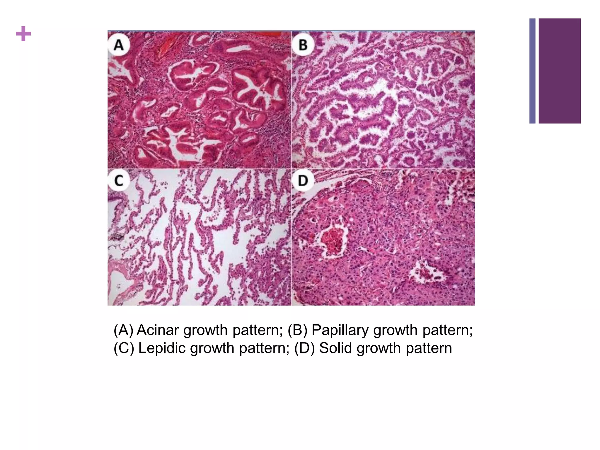 Lung Cancer Pathology & Clinical | PPTX