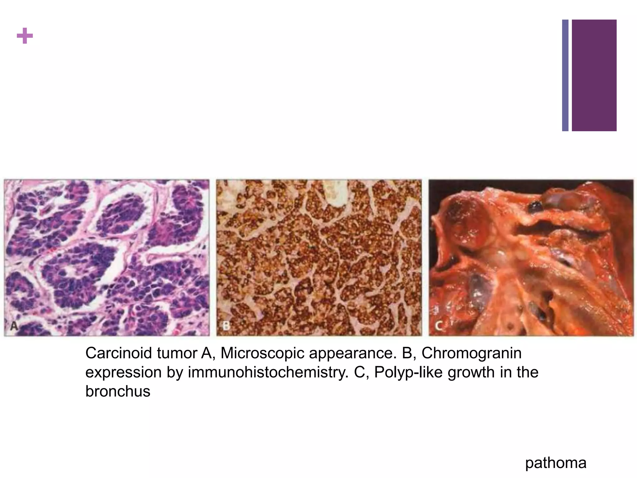 Lung Cancer Pathology & Clinical | PPTX