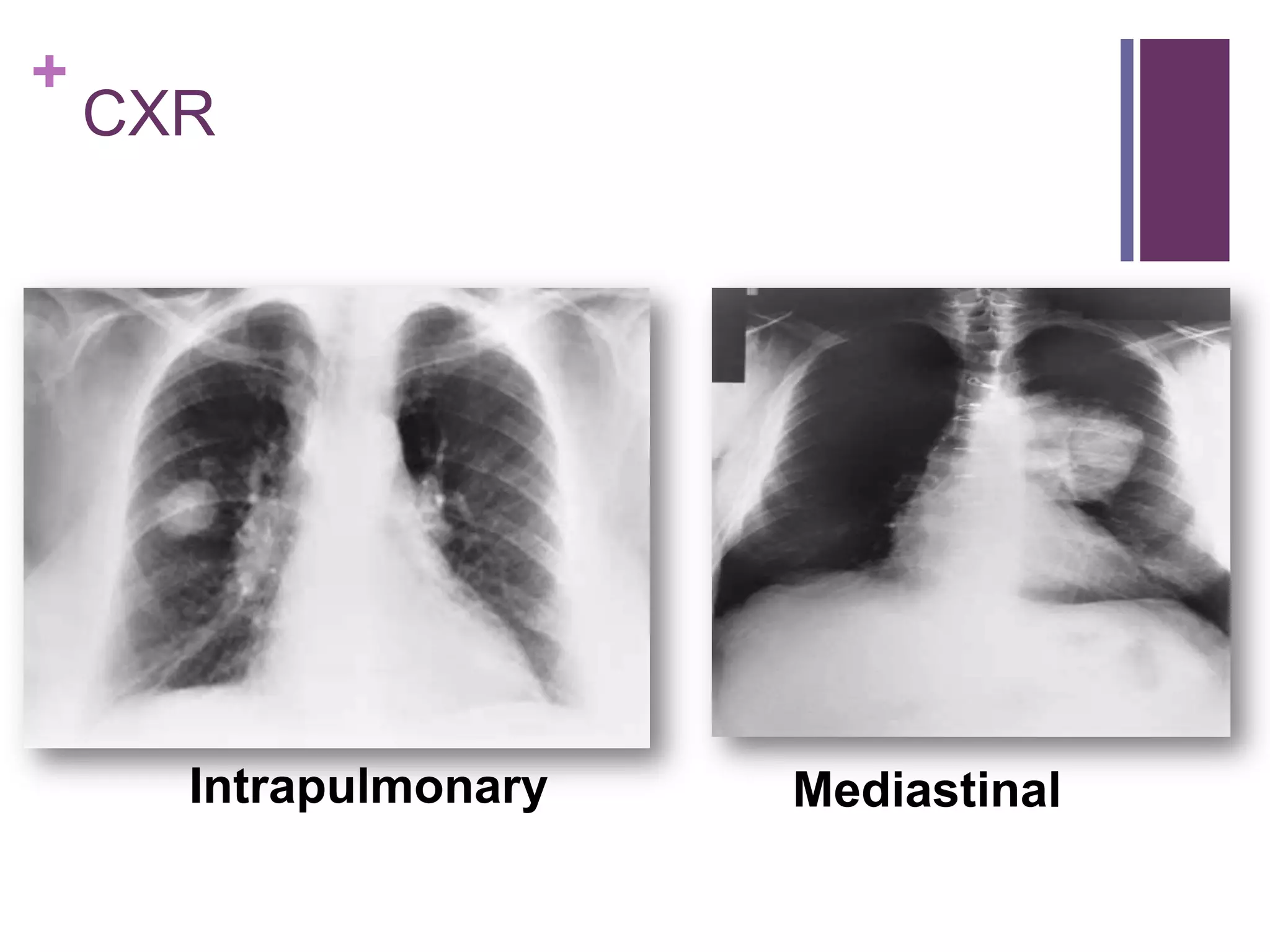 Lung Cancer Pathology & Clinical | PPTX