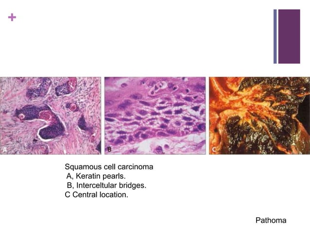 Lung Cancer Pathology & Clinical | PPTX