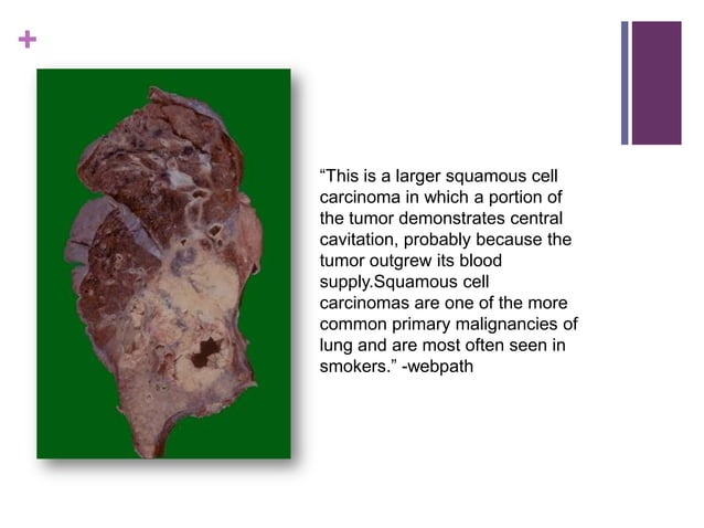 Lung Cancer Pathology & Clinical | PPTX