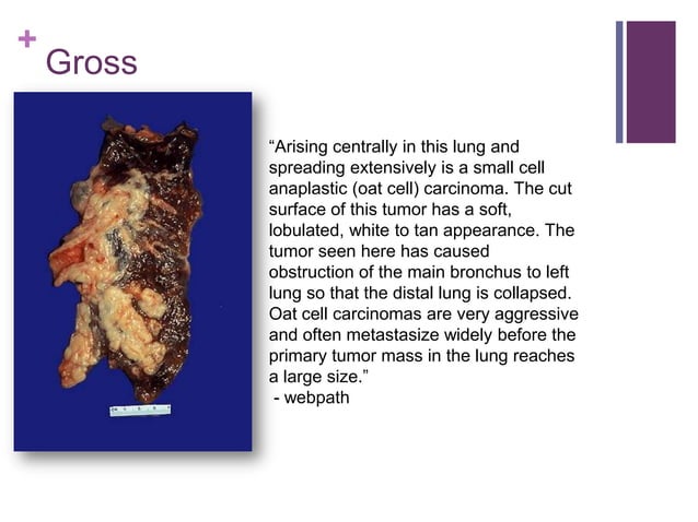 Lung Cancer Pathology & Clinical | PPTX