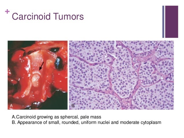 Lung Cancer Pathology & Clinical