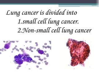 Lung cancer | PPT