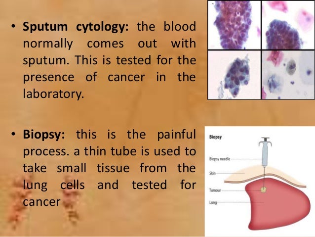 Lung And Lung Cancer Symptoms An Overview