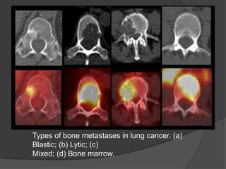 Lung cancer | PPTX