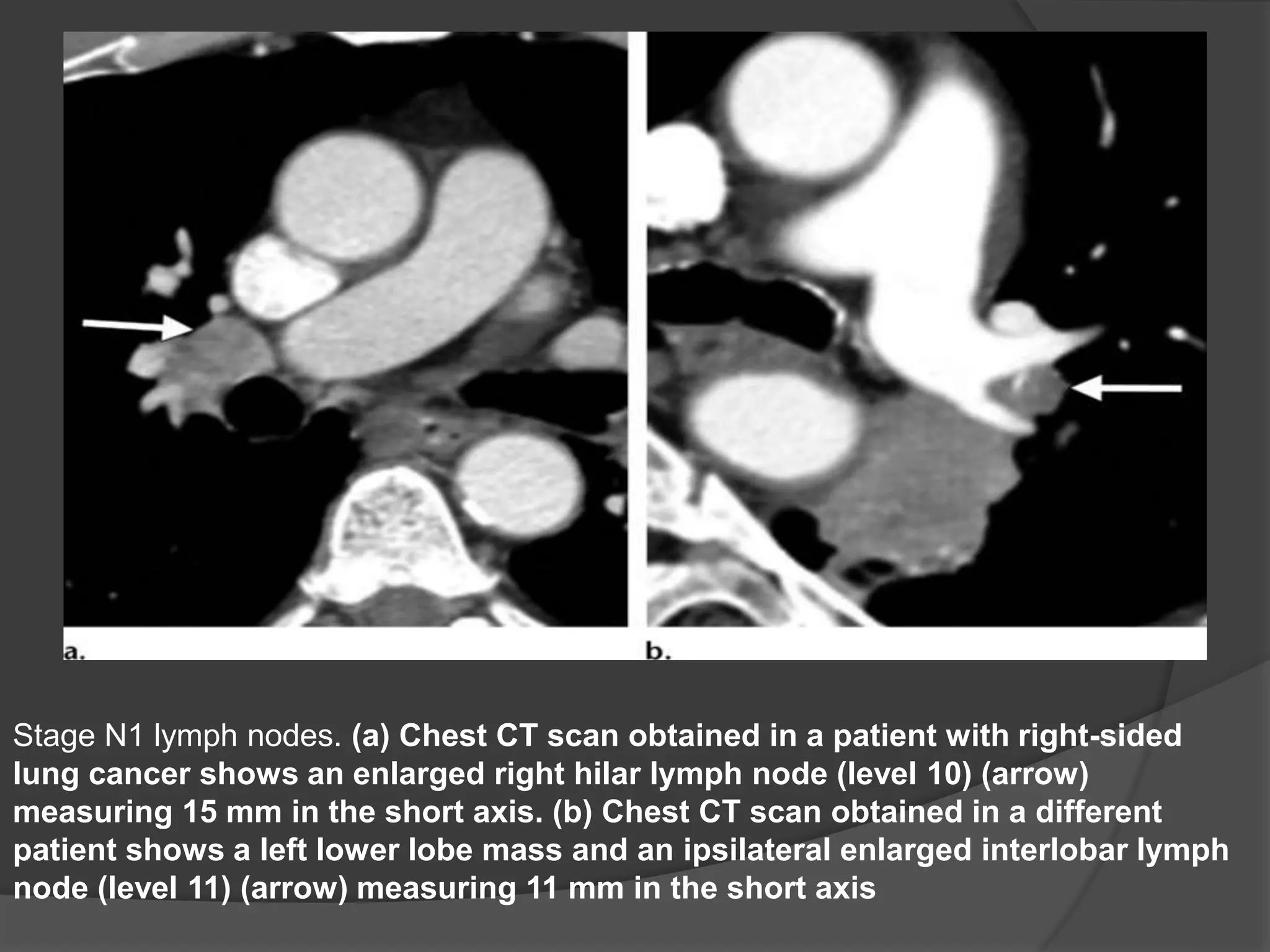 Lung cancer radiology | PPTX