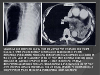 Lung cancer radiology | PPTX