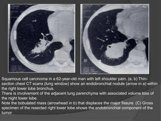 Lung cancer radiology | PPTX
