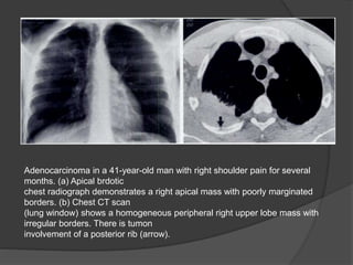Lung cancer radiology | PPTX
