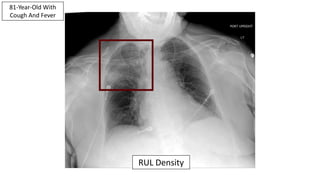EMGuideWire's Radiology Reading Room: Lung Cancer | PPTX