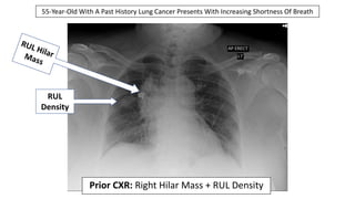 EMGuideWire's Radiology Reading Room: Lung Cancer | PPTX