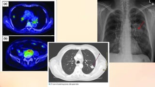 Lung cancer-medical discussion | study | PPTX