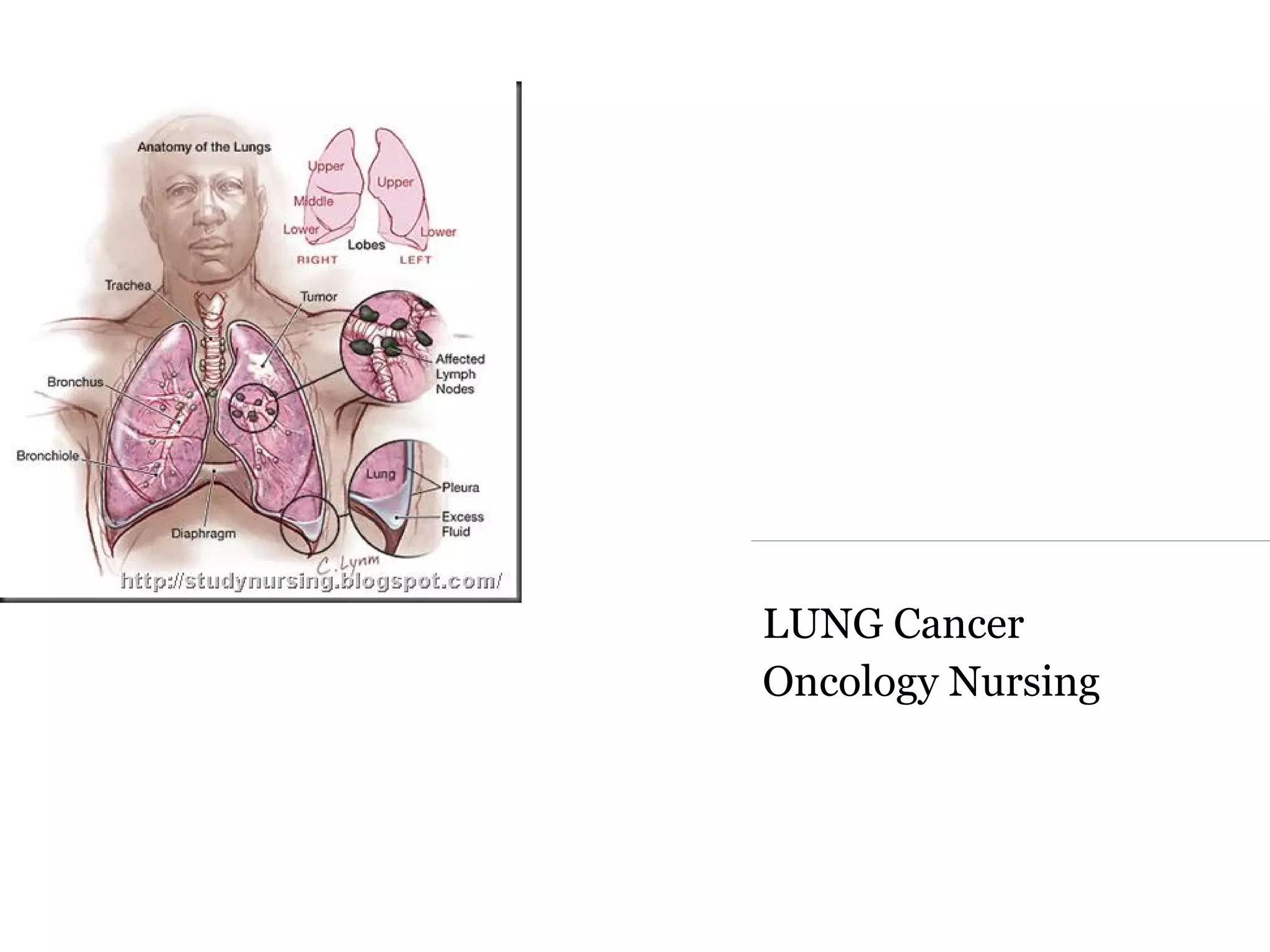 Lung cancer | PDF