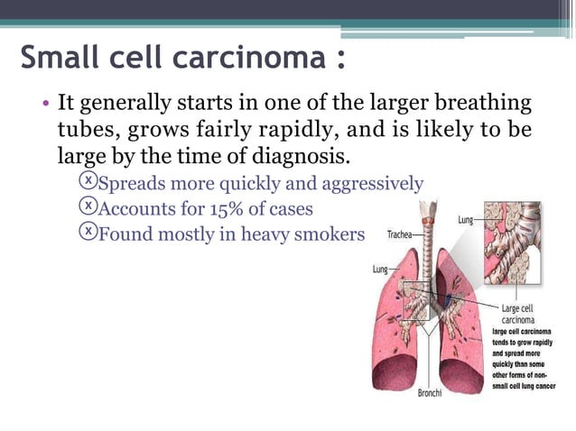 Lung cancer | PDF