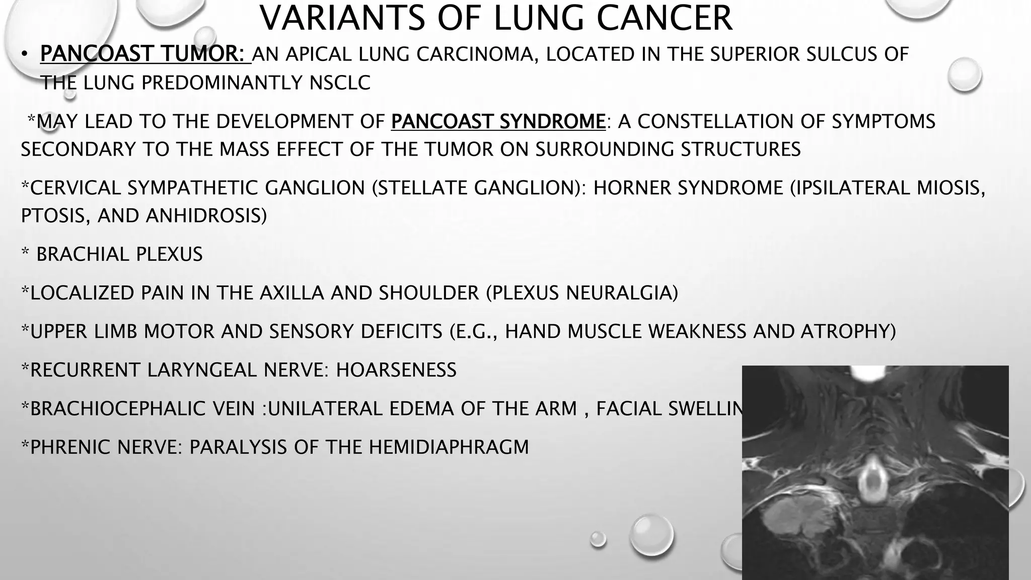 Lung cancer .pptx