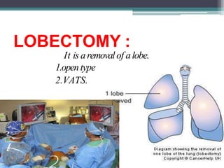 lung cancer.pptx