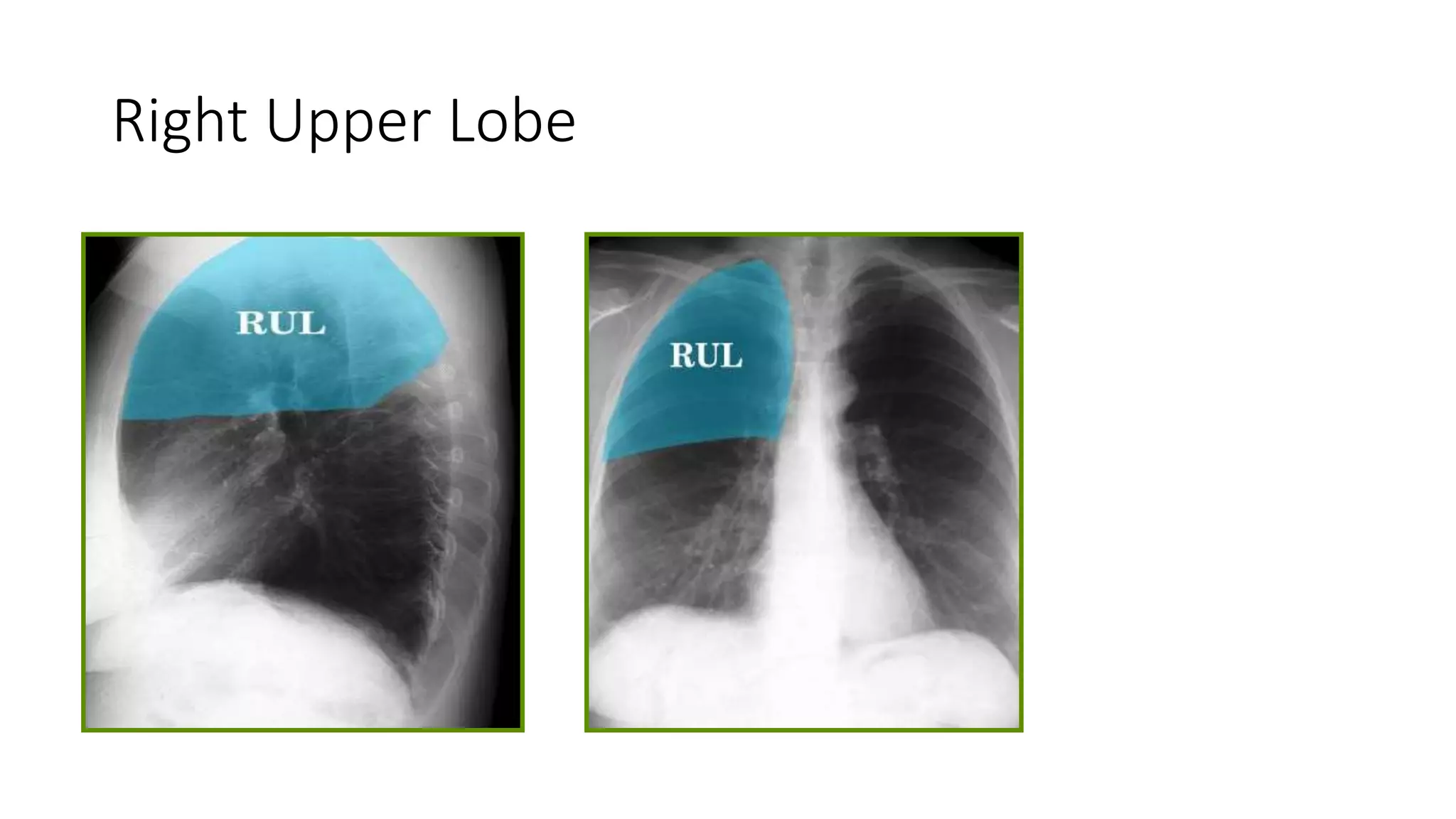 Lung cancer anatomy to pathological classification | PPTX