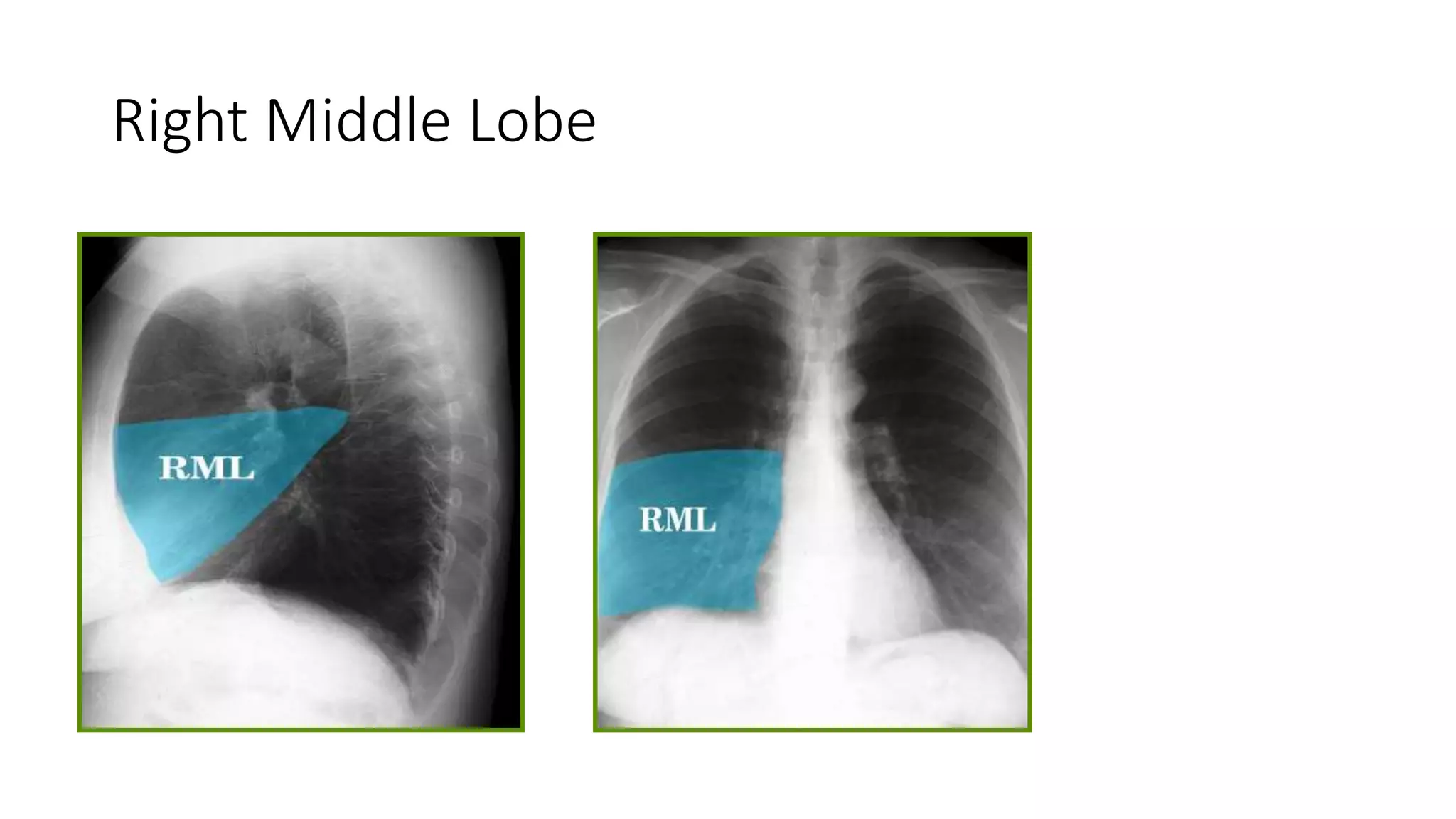 Lung cancer anatomy to pathological classification | PPTX