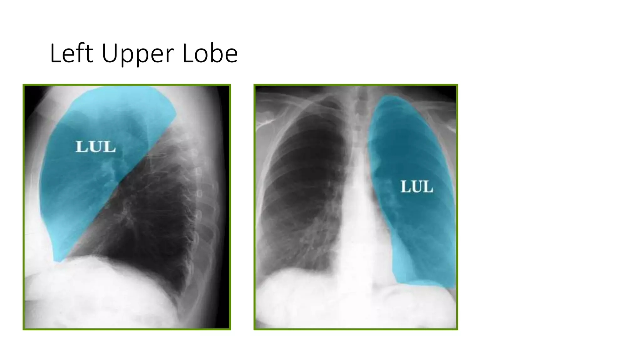 Lung cancer anatomy to pathological classification | PPTX