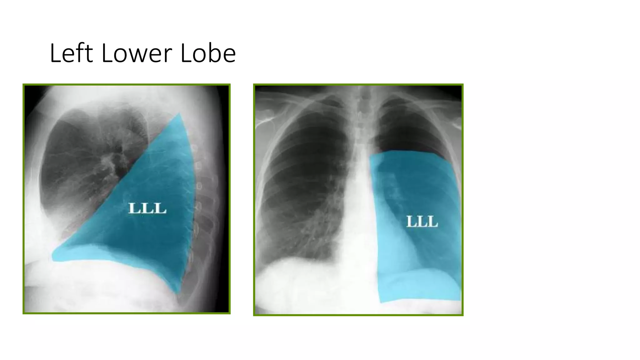 Lung cancer anatomy to pathological classification | PPTX