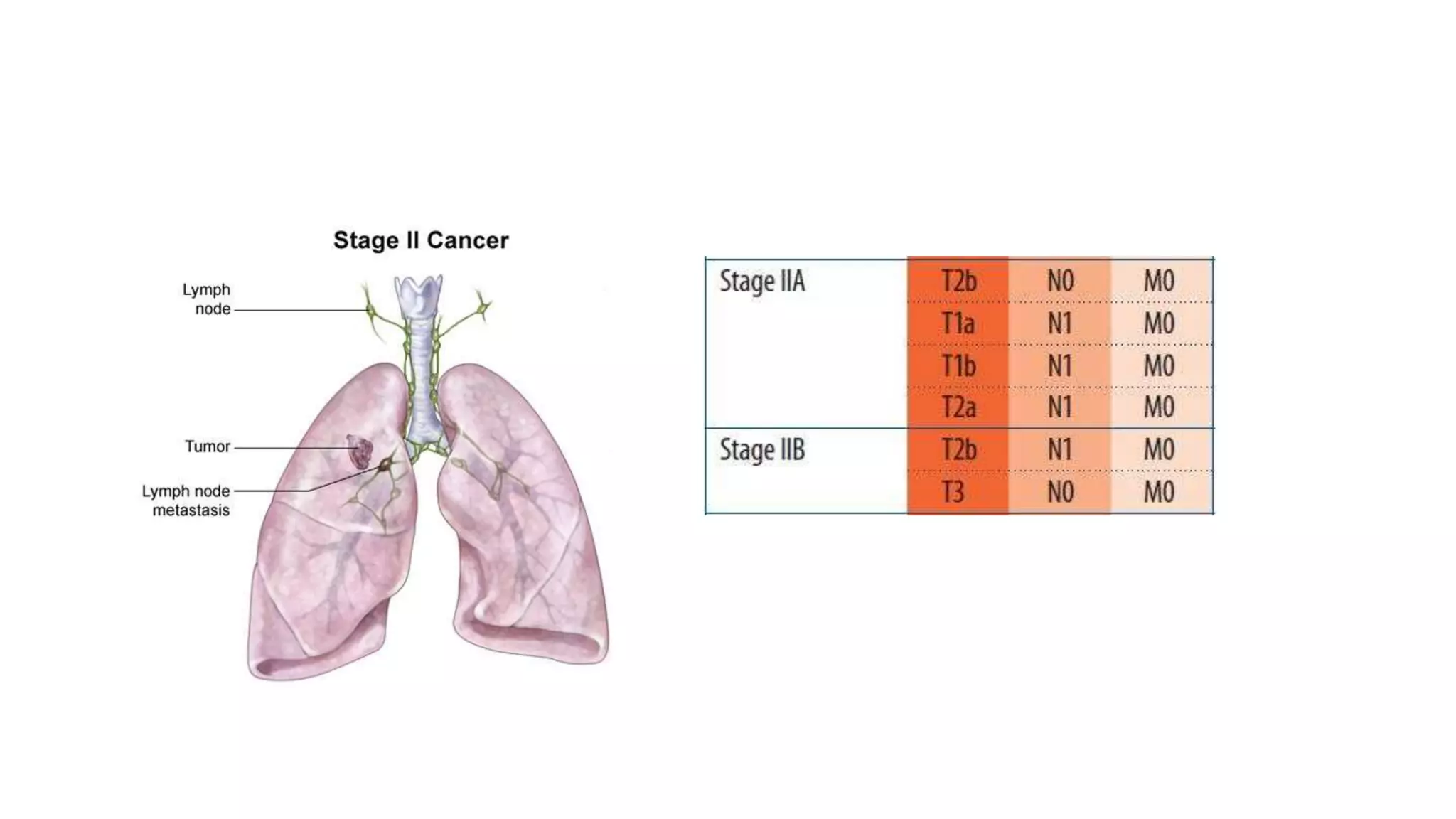 Lung cancer anatomy to pathological classification | PPTX