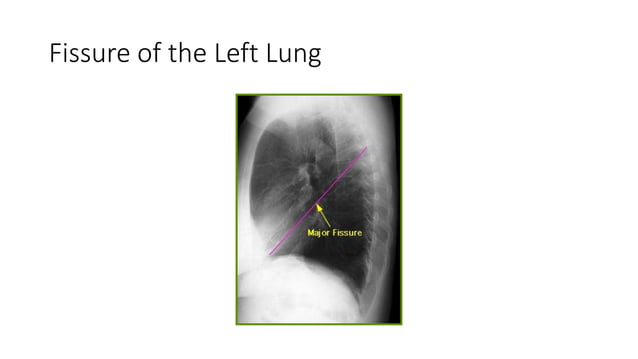 Lung cancer anatomy to pathological classification | PPTX | Lung and ...