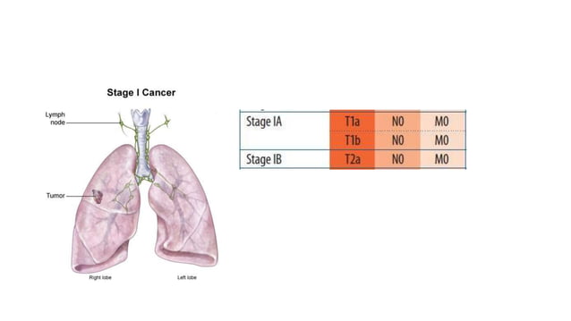 Lung cancer anatomy to pathological classification | PPTX | Lung and ...