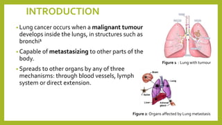 LUNG CANCER | PPTX