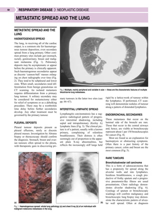 Lung cancer primary and metastatic | PDF