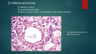 Lung Cancer - Rivin | PPTX