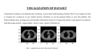 Lung Cancer Detection using transfer learning.pptx.pdf