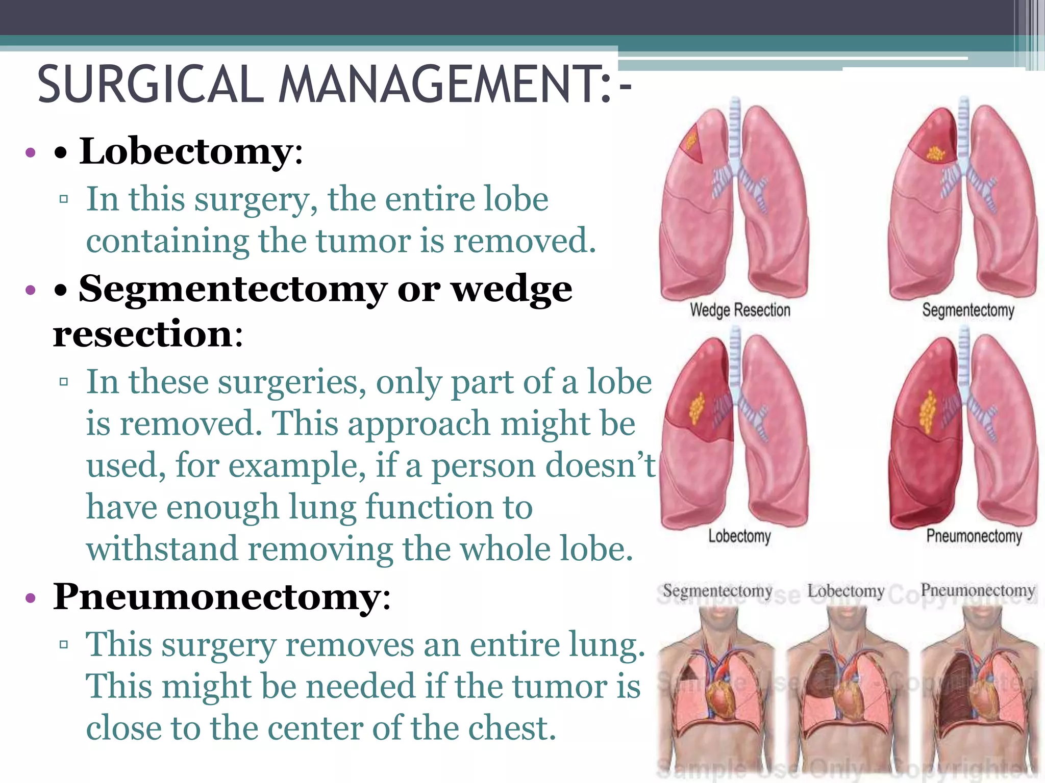 Lung cancer ppt | PPT