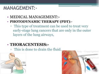 Lung cancer ppt | PPTX